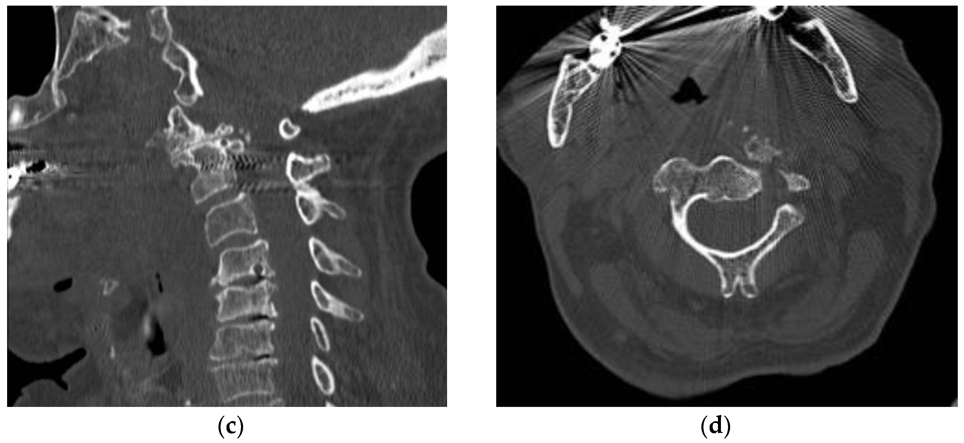 A Three-Step Submandibular Retropharyngeal Approach to the ...