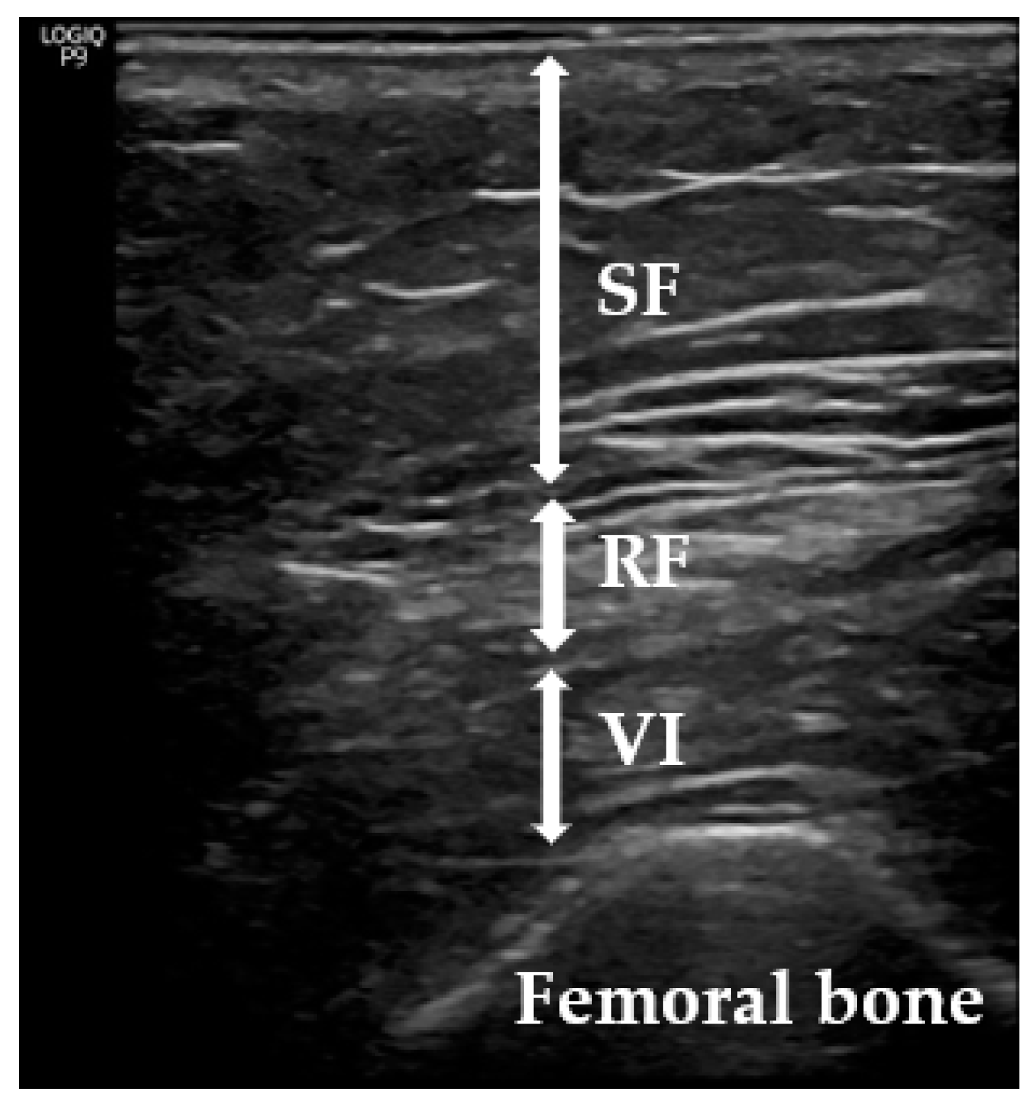 Prospective Study to Evaluate Rectus Femoris Muscle Ultrasound for Body ...
