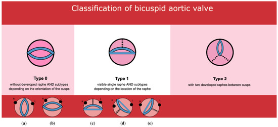 JCM | Free Full-Text | Patients with a Bicuspid Aortic Valve (BAV ...