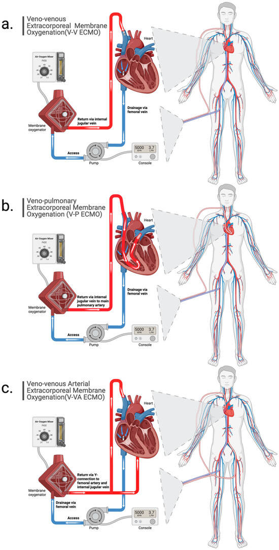 Extracorporeal Membrane Oxygenation for Respiratory Failure: A ...