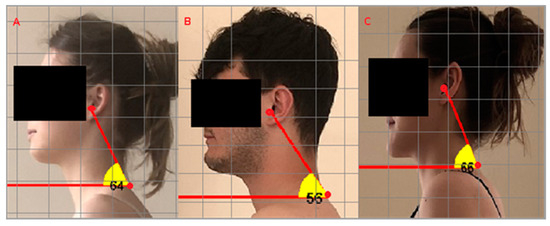 Assessment of the Relationship between Antero-Posterior Dental ...