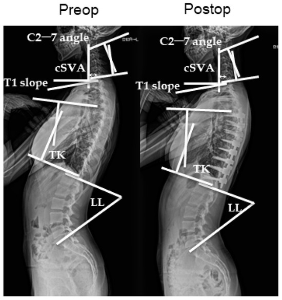 Incidence of Cervical Kyphosis and Factors Associated with Improvement in Postoperative Cervical ...