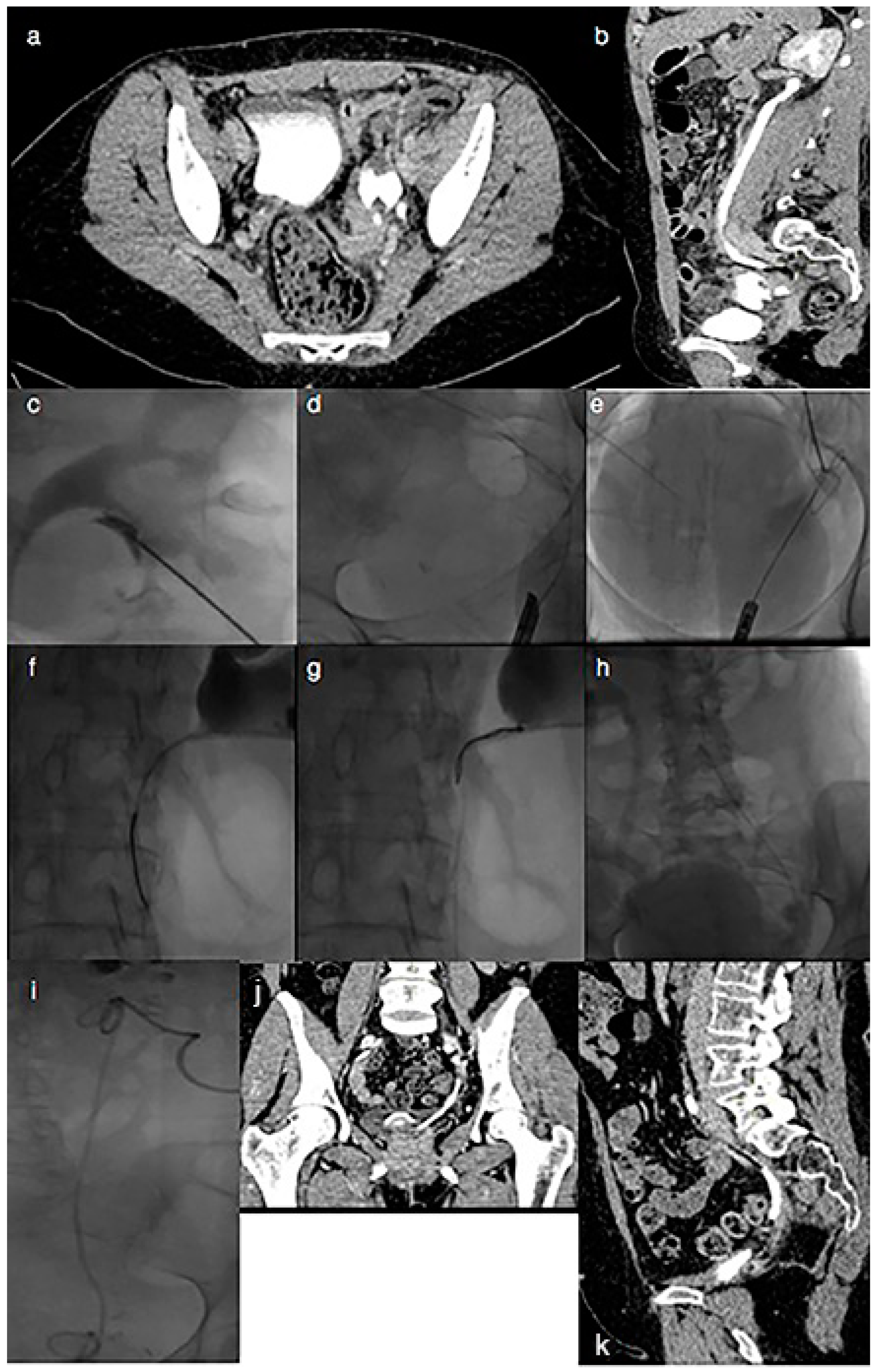 The Rendezvous Technique: A Minimally Invasive Non-Surgical Approach ...