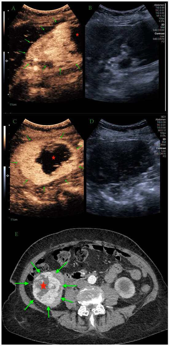 Contrast-Enhanced Ultrasound in the Diagnosis of Solid Renal Lesions