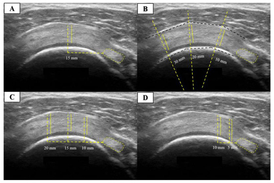 Metrology of Supraspinatus Tendon Thickness in Swimmers with ...