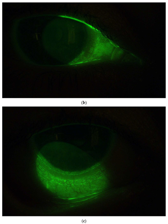 Jcm Free Full Text Scleral Lenses For Managing Dry Eye Disease In