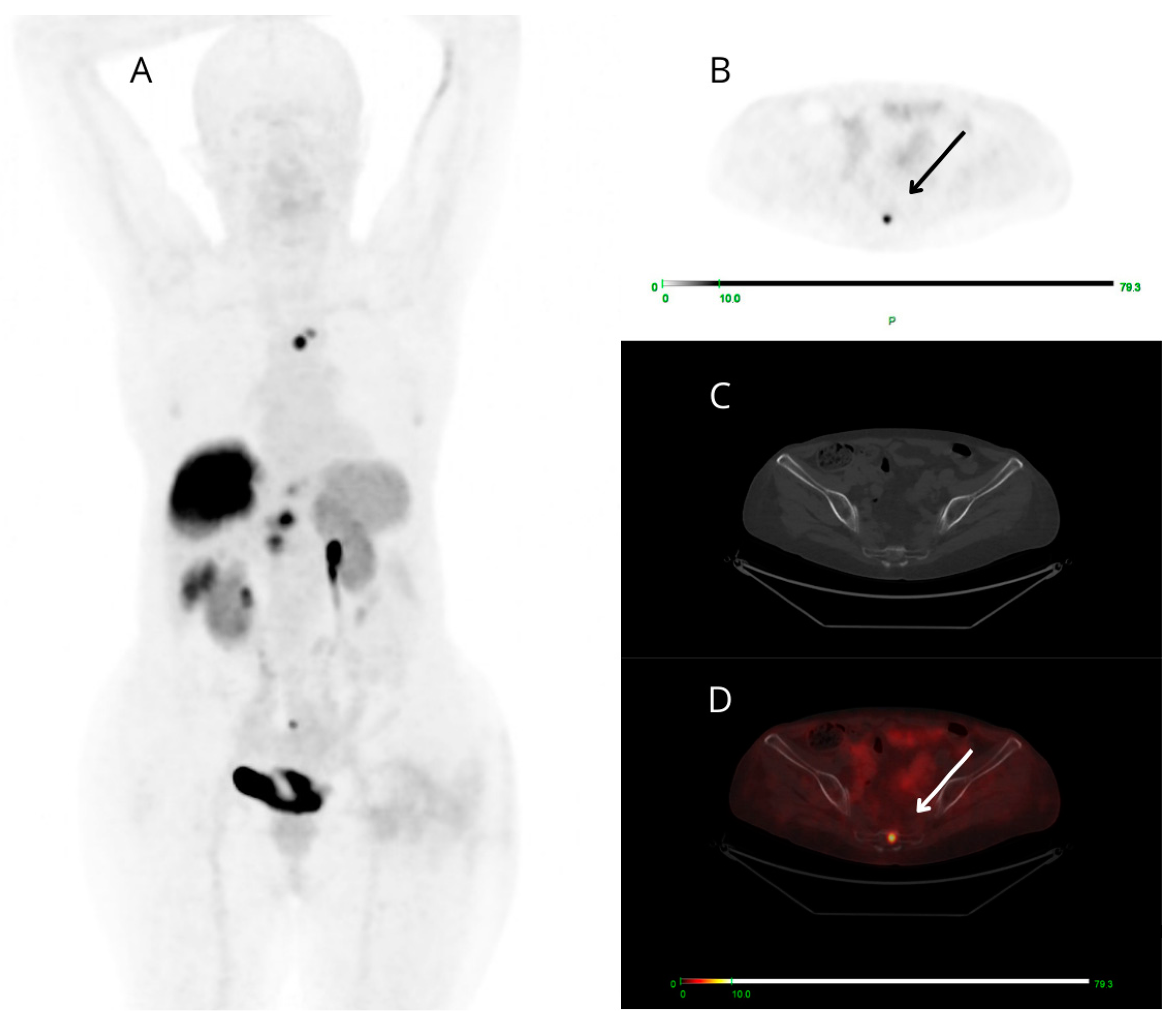 β1600 Q.Clear Digital Reconstruction of [68Ga]Ga-DOTANOC PET/CT ...