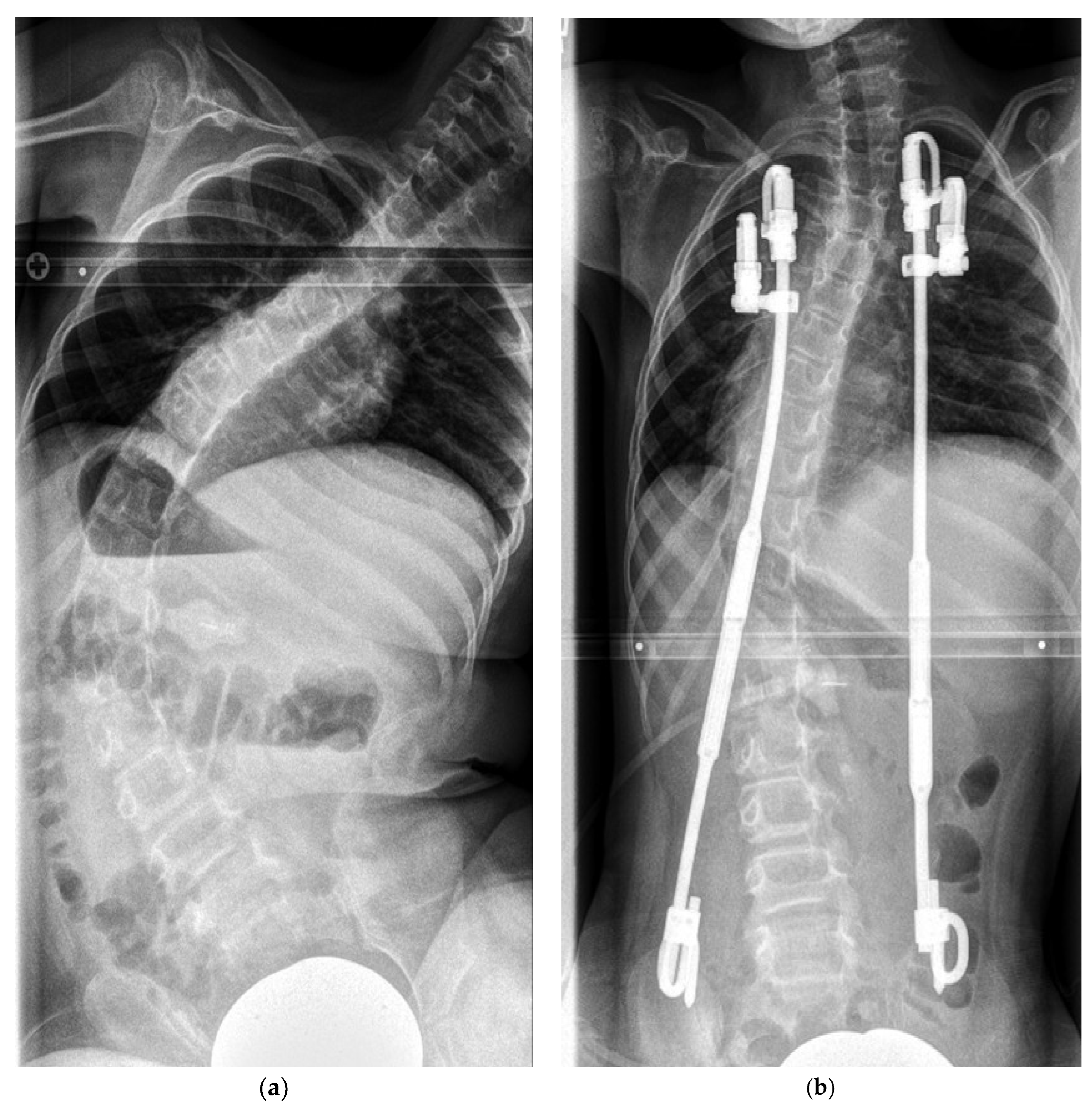 JCM | Free Full-Text | Pelvic Fixation for Non-Ambulatory Patients with ...