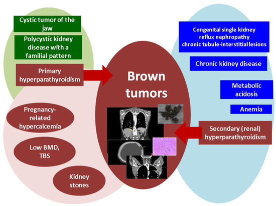 Brown Tumors: The Hidden Face of Primary and Renal Hyperparathyroidism ...