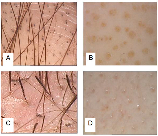 A New Method for the Follow-Up of Patients with Alopecia Areata