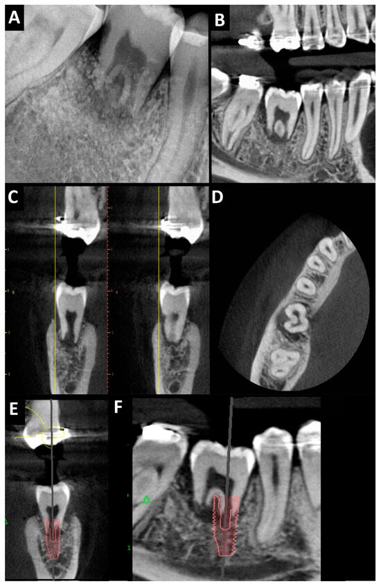 Tooth Autotransplantation, Autogenous Dentin Graft, and Growth Factors ...