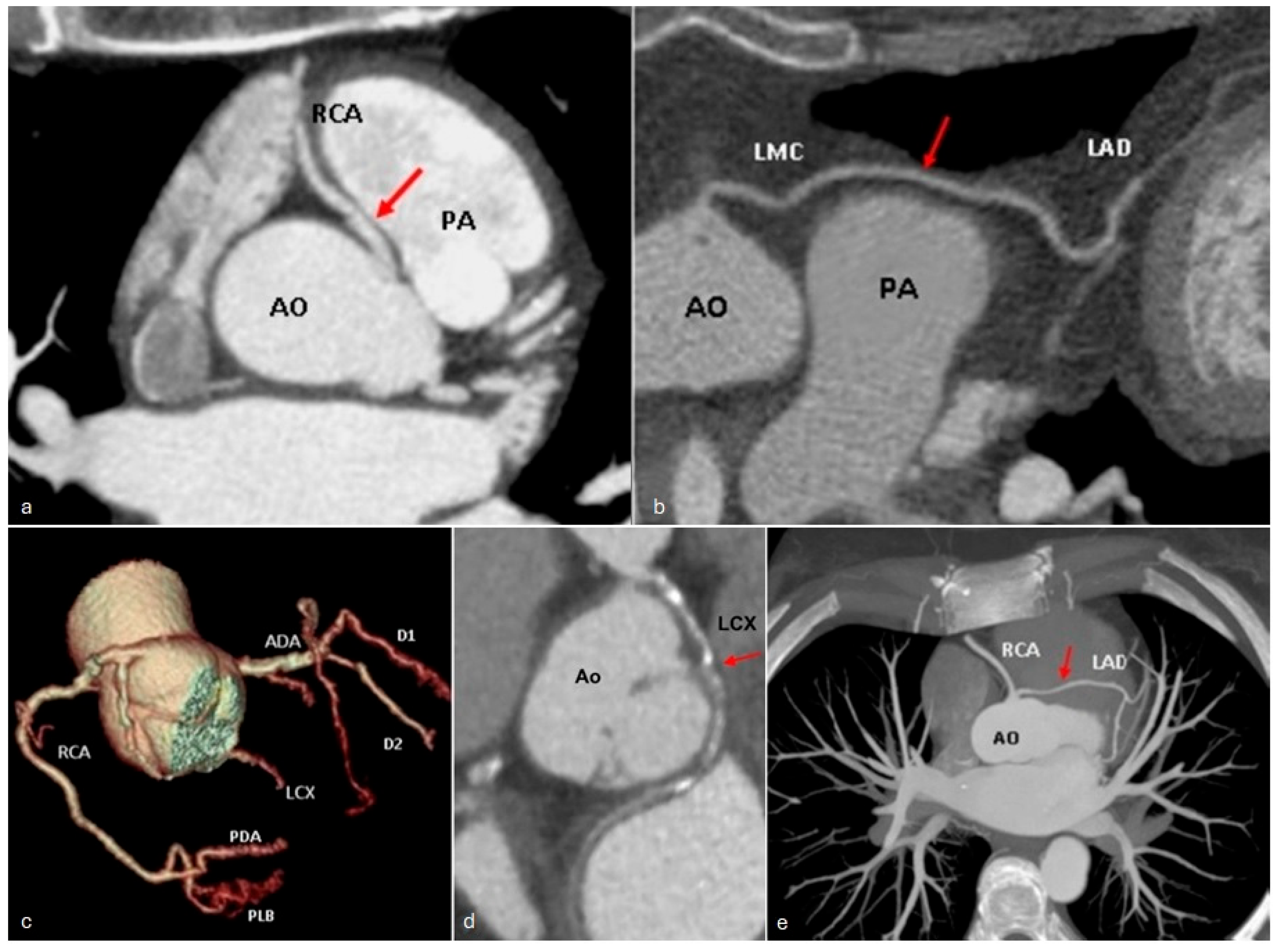 Coronary Artery Anomalies: A Computed Tomography Angiography Pictorial ...