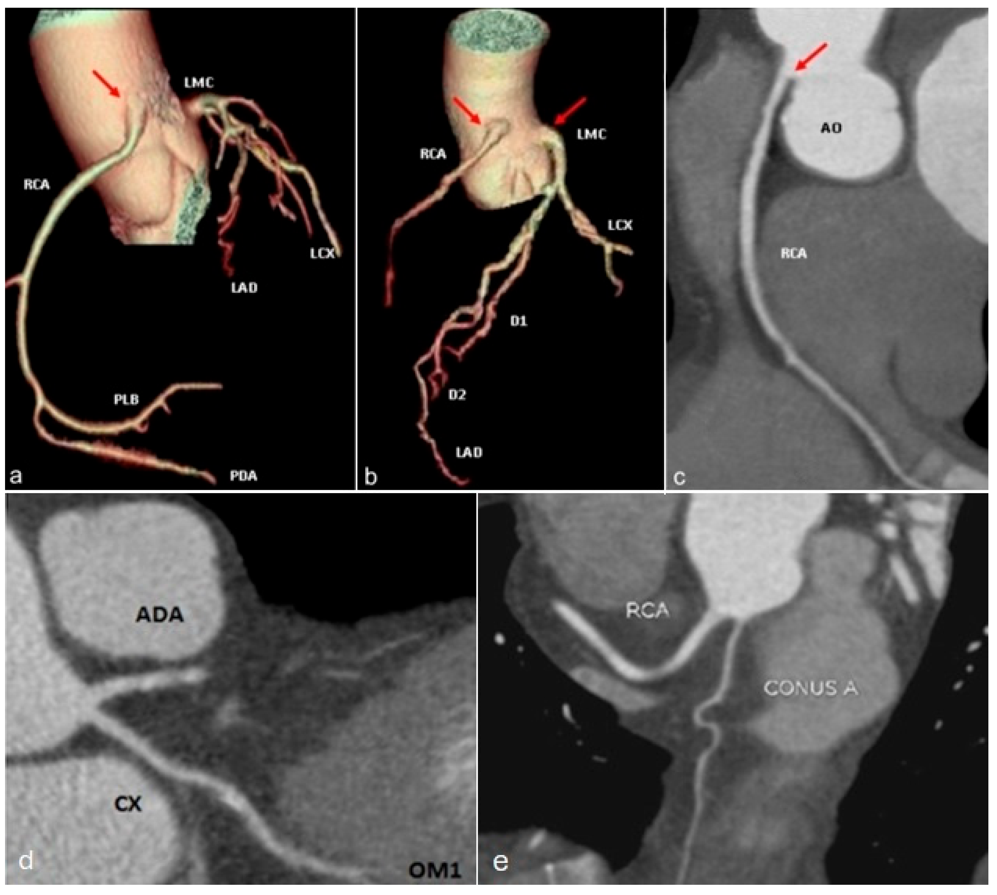 JCM | Free Full-Text | Coronary Artery Anomalies: A Computed Tomography ...