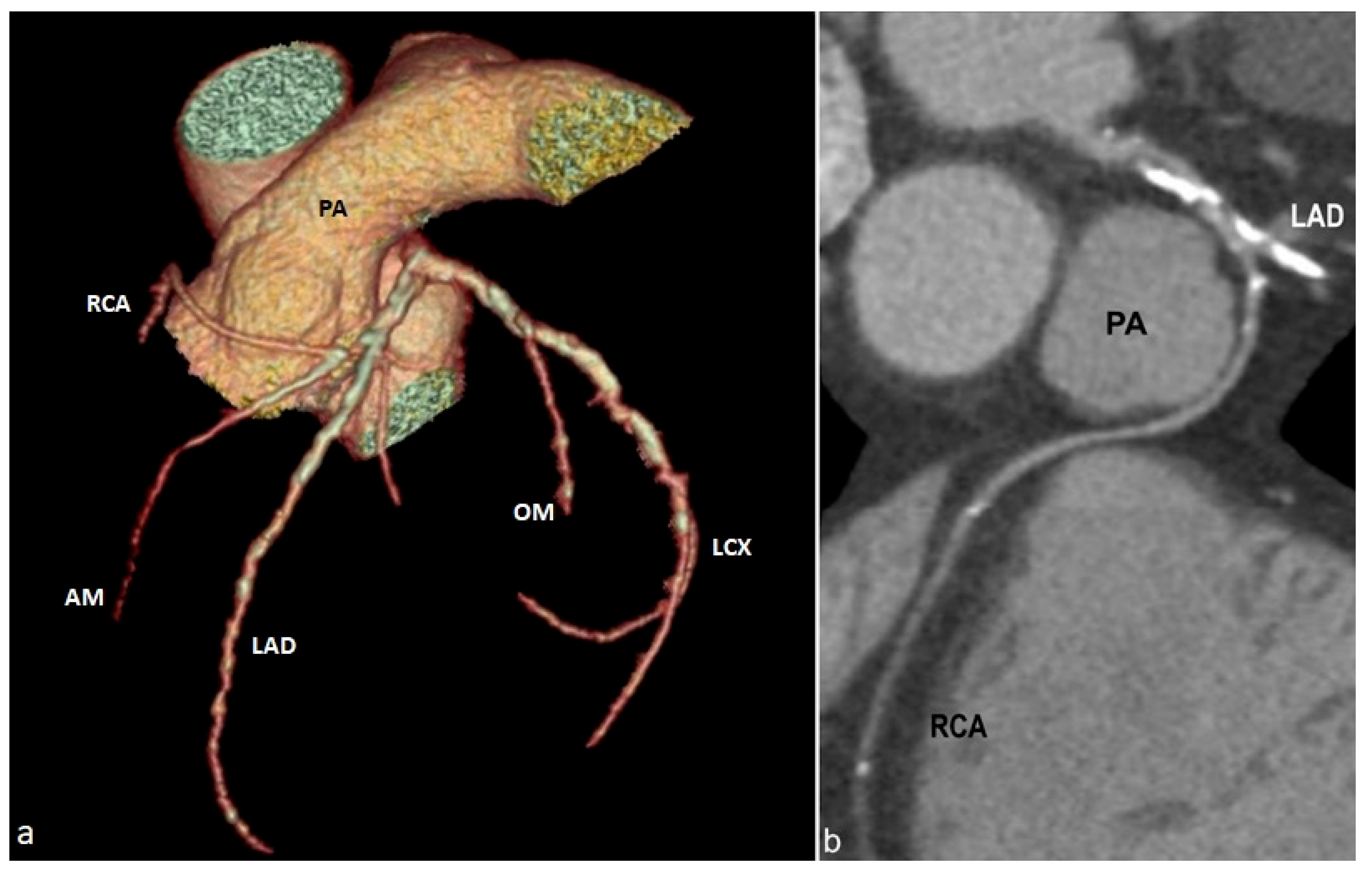 JCM | Free Full-Text | Coronary Artery Anomalies: A Computed Tomography ...