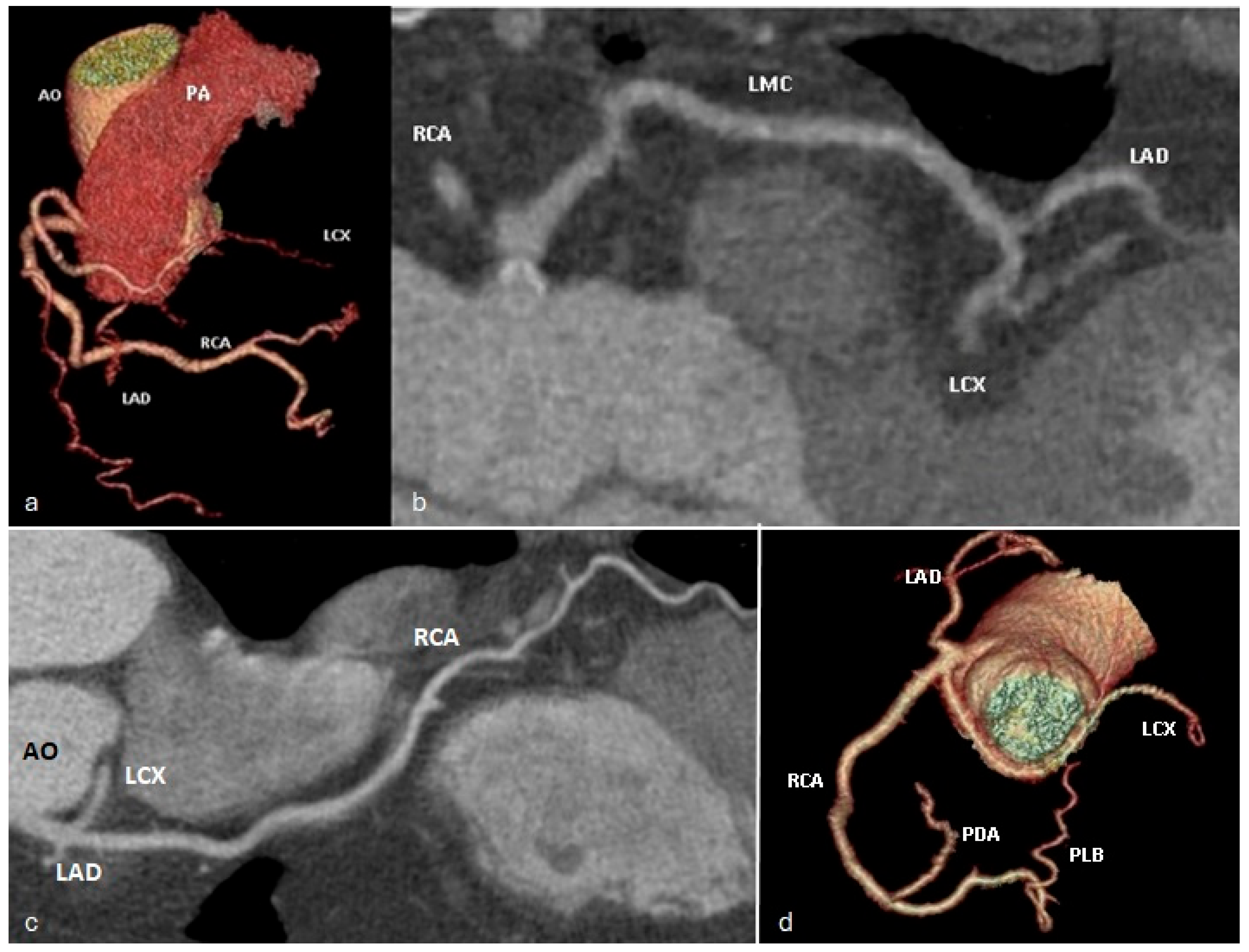 JCM | Free Full-Text | Coronary Artery Anomalies: A Computed Tomography Angiography Pictorial Review