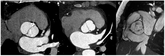 Aortic Regurgitation in Bicuspid Aortic Valve: The Role of ...
