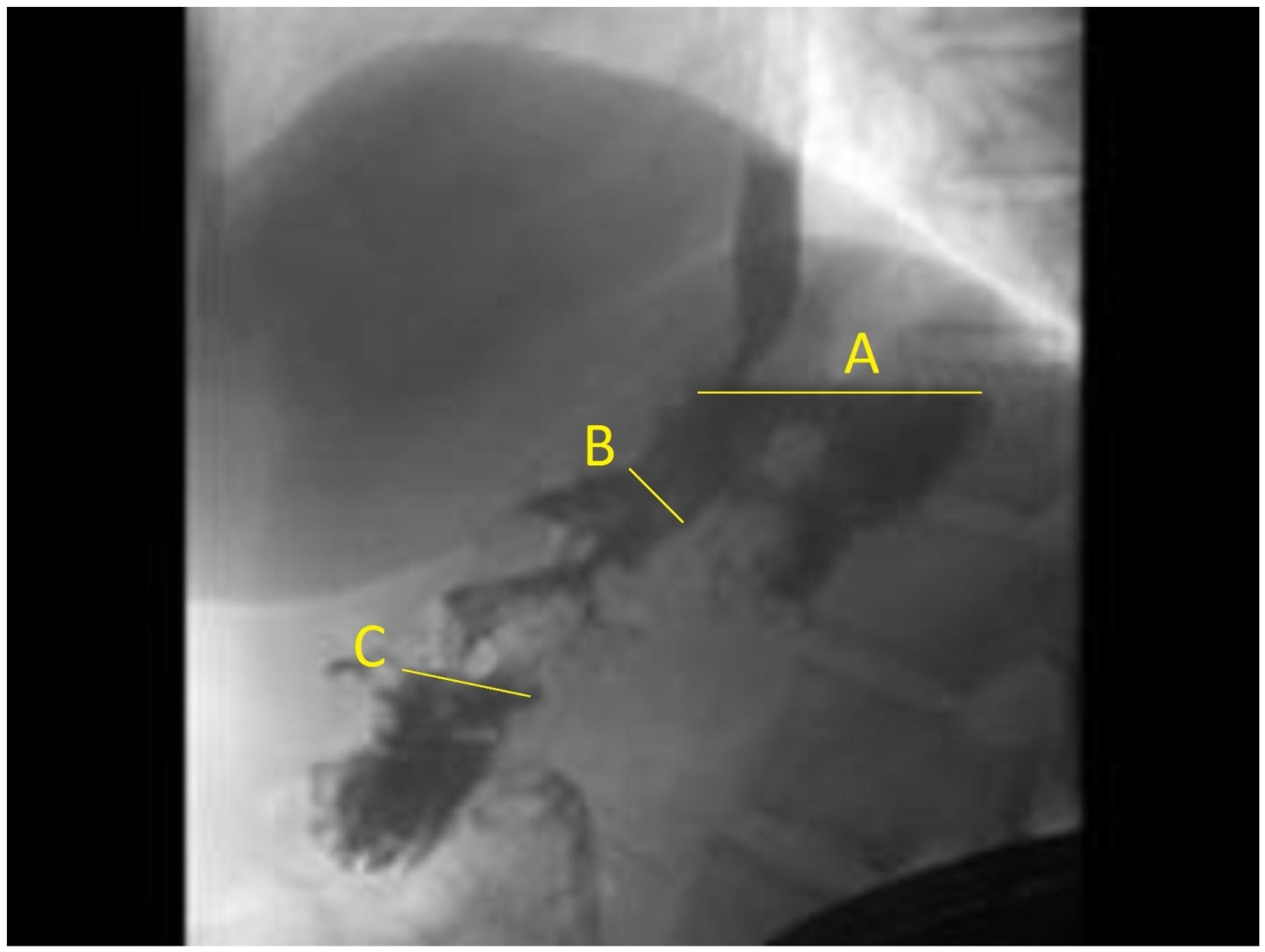 Fundus-to-Antrum Ratio Measured with Fluoroscopy within One Week after ...