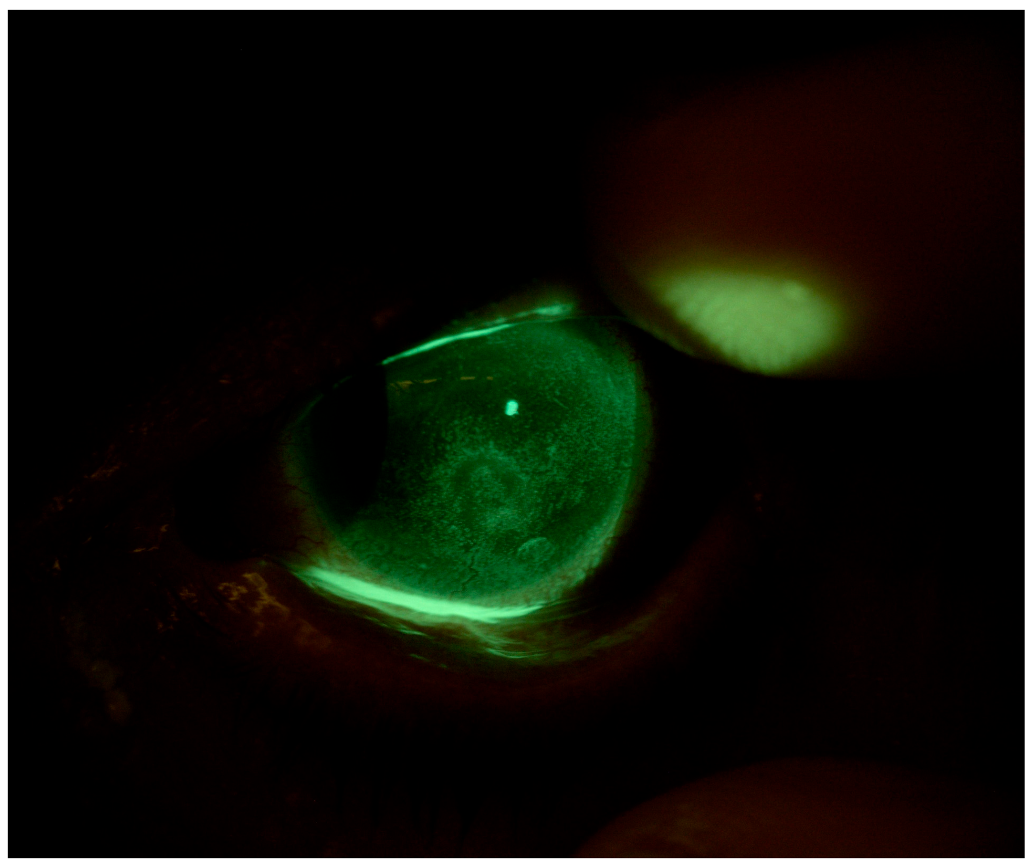 Customized Scleral Lenses: An Alternative Tool for Severe Dry Eye ...