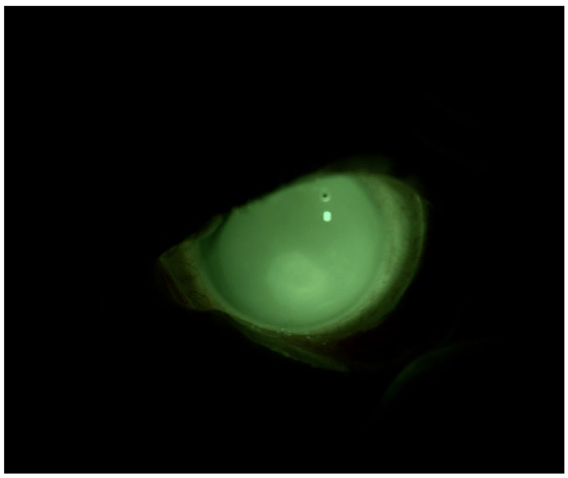 Customized Scleral Lenses: An Alternative Tool for Severe Dry Eye ...
