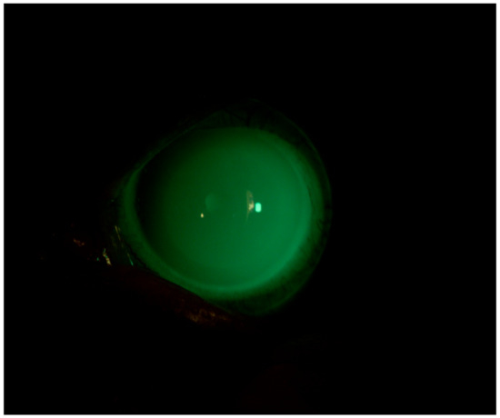 Customized Scleral Lenses: An Alternative Tool for Severe Dry Eye ...