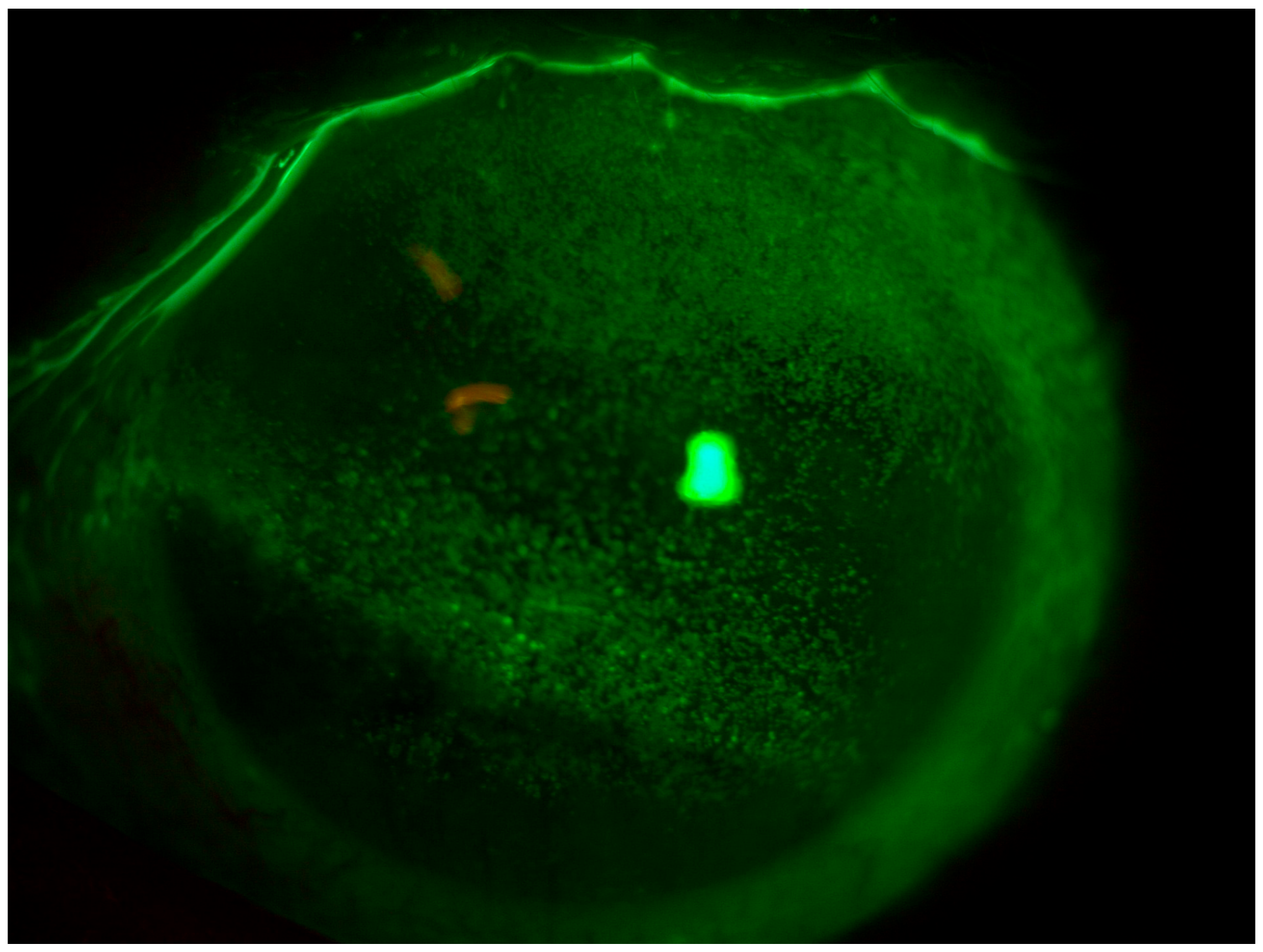 Customized Scleral Lenses: An Alternative Tool for Severe Dry Eye ...