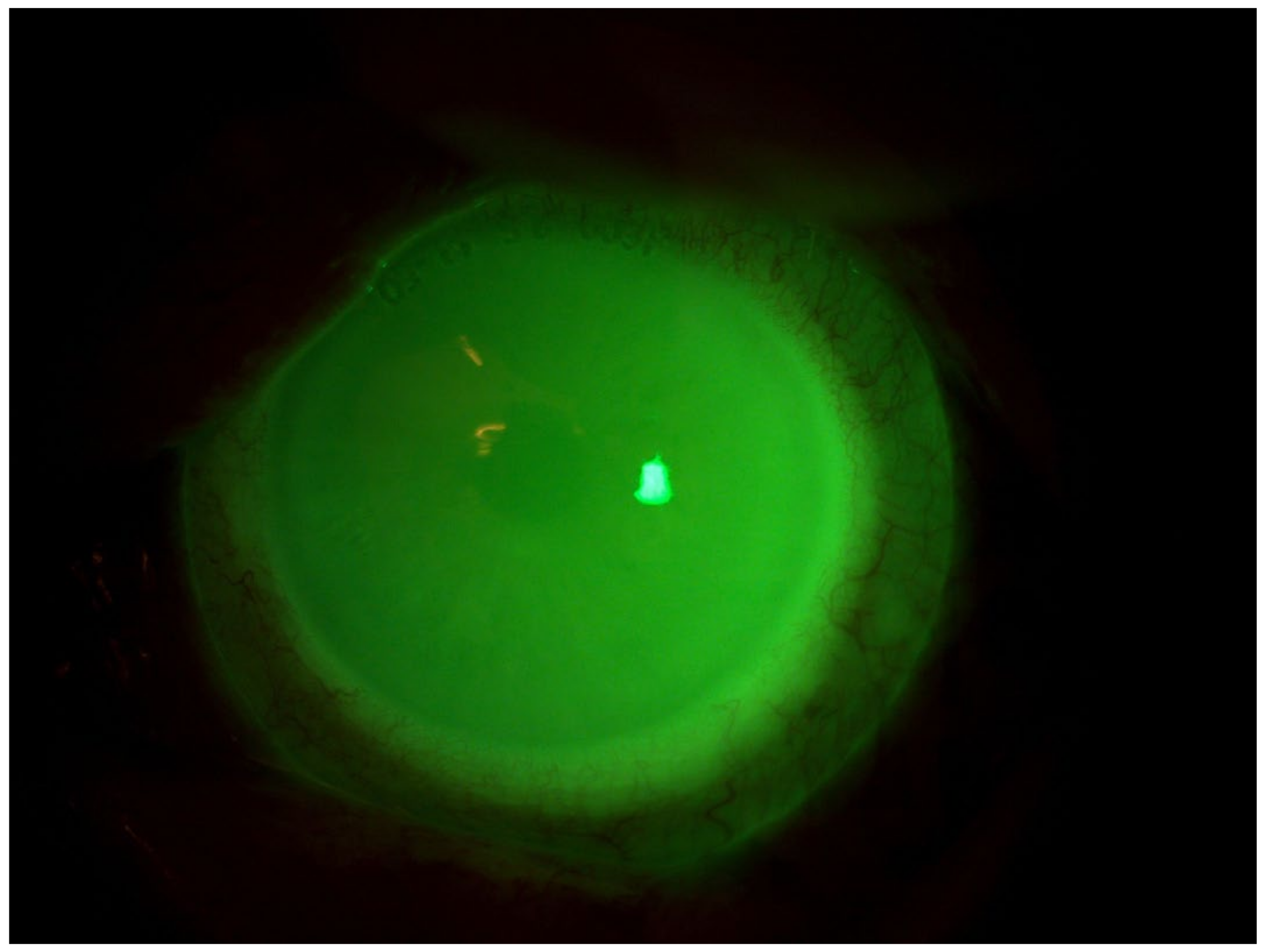 Customized Scleral Lenses: An Alternative Tool for Severe Dry Eye ...