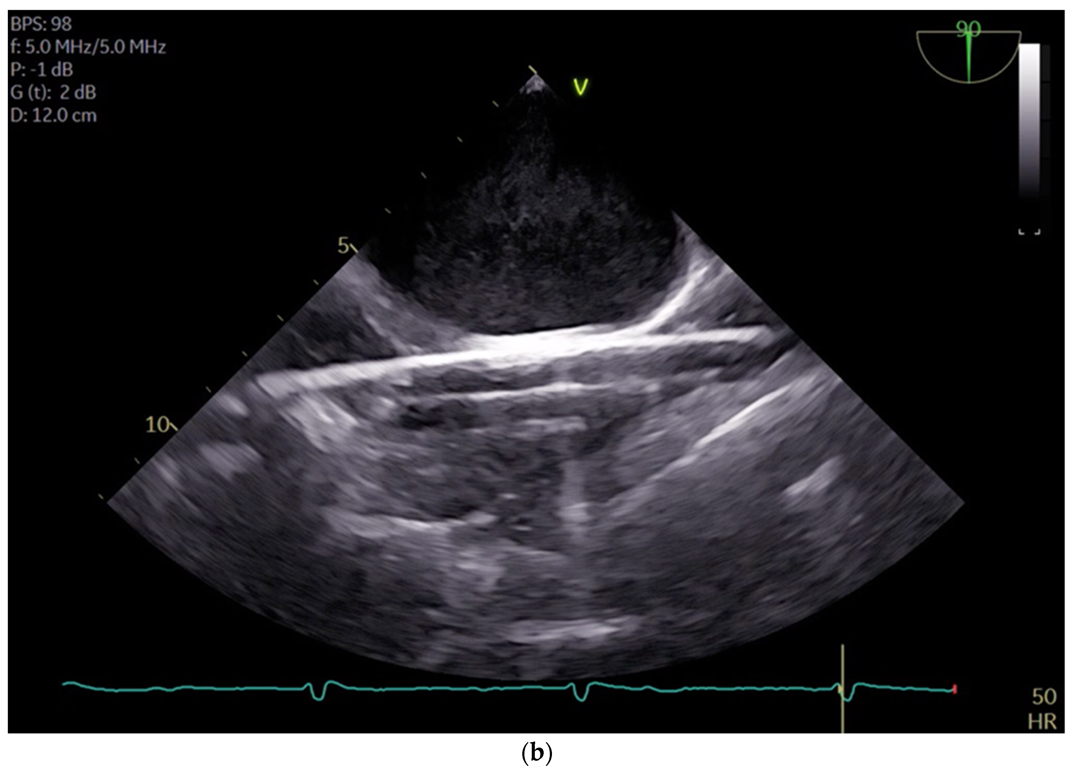 Anesthesia for Minimal Invasive Cardiac Surgery: The Bonn Heart Center ...