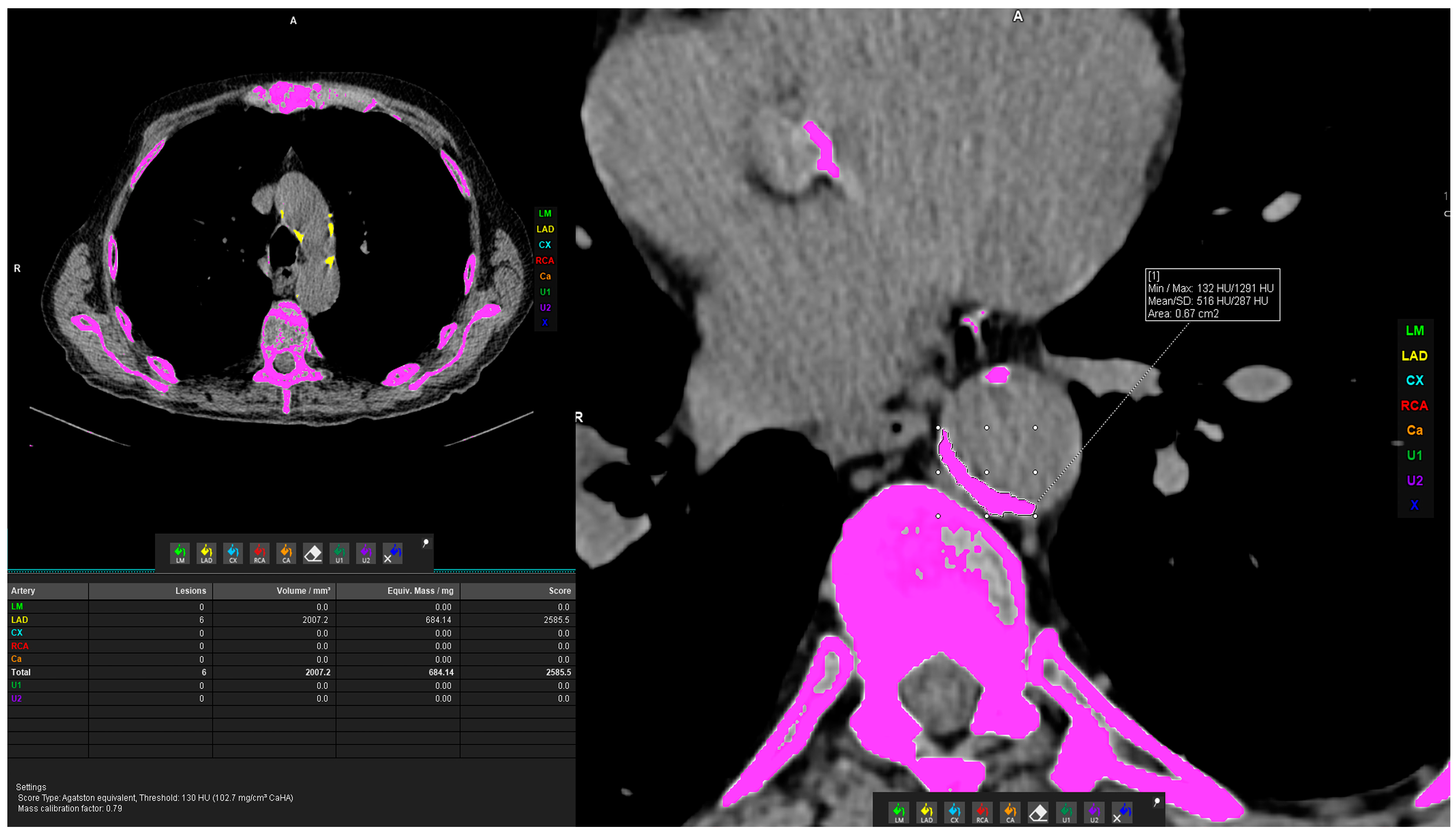 Is Type and Grade of Emphysema Important for Bone Mineral Density and ...