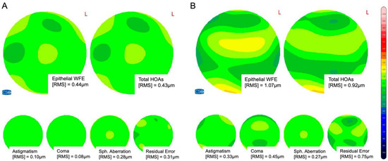Epithelial Remodeling and Epithelial Wavefront Aberrometry after ...