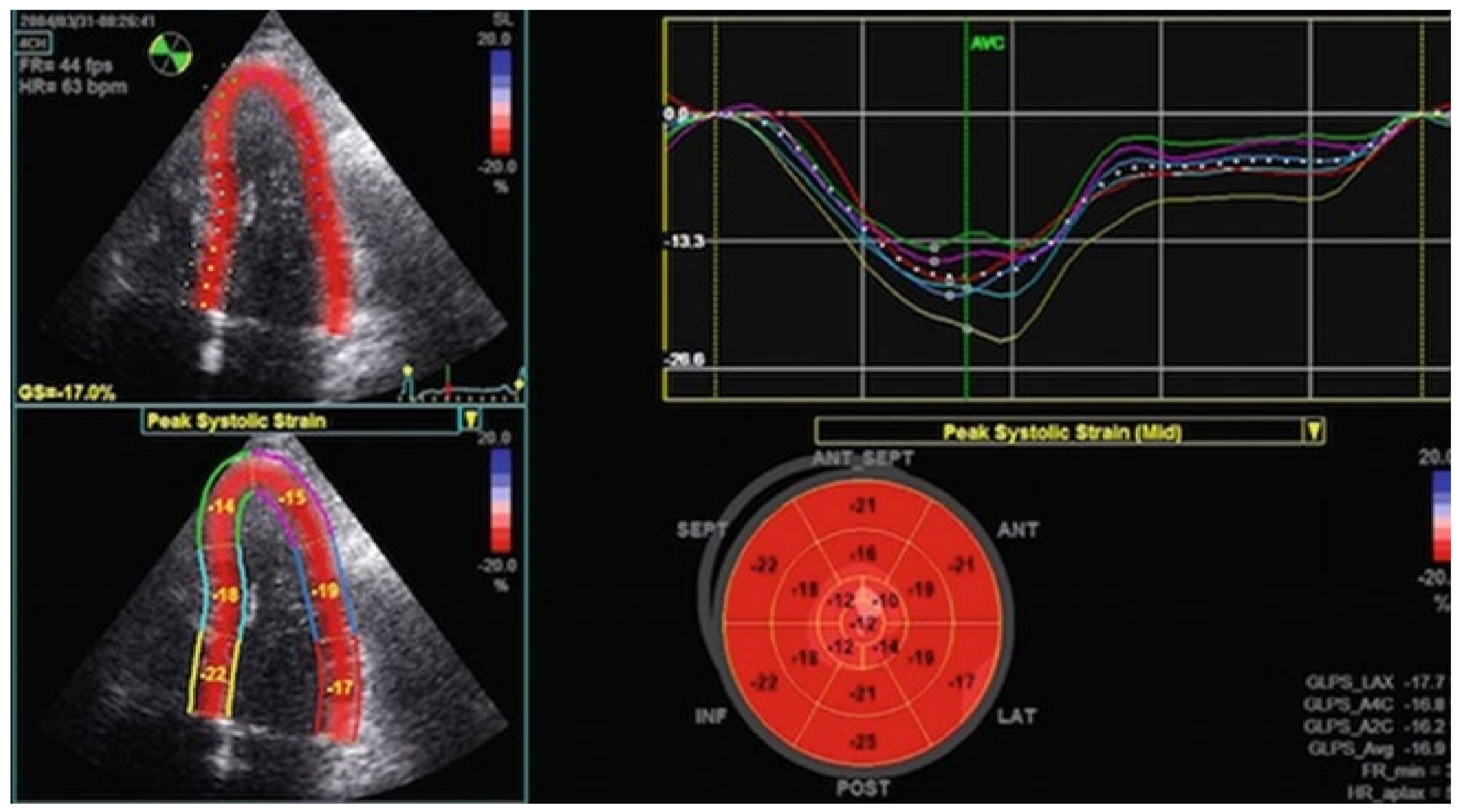 The Role of Speckle Tracking Echocardiography in the Evaluation of Advanced-Heart-Failure Patients