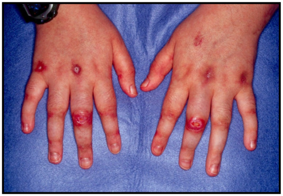 A Review of Myositis-Associated Interstitial Lung Disease