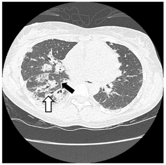 A Review of Myositis-Associated Interstitial Lung Disease