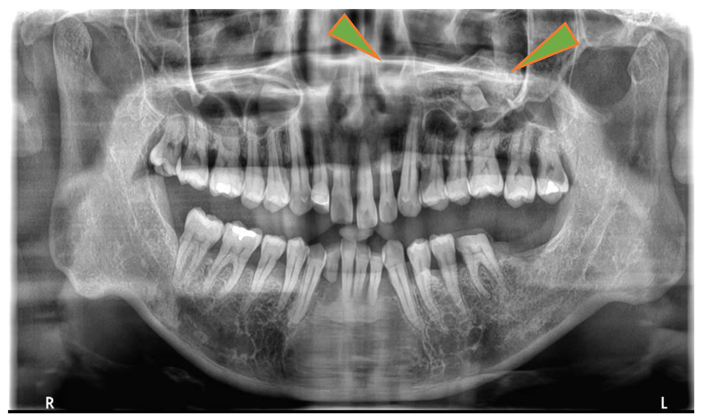 A Unique Case of Supernumerary Teeth Erupting Inside a Maxillary Sinus ...