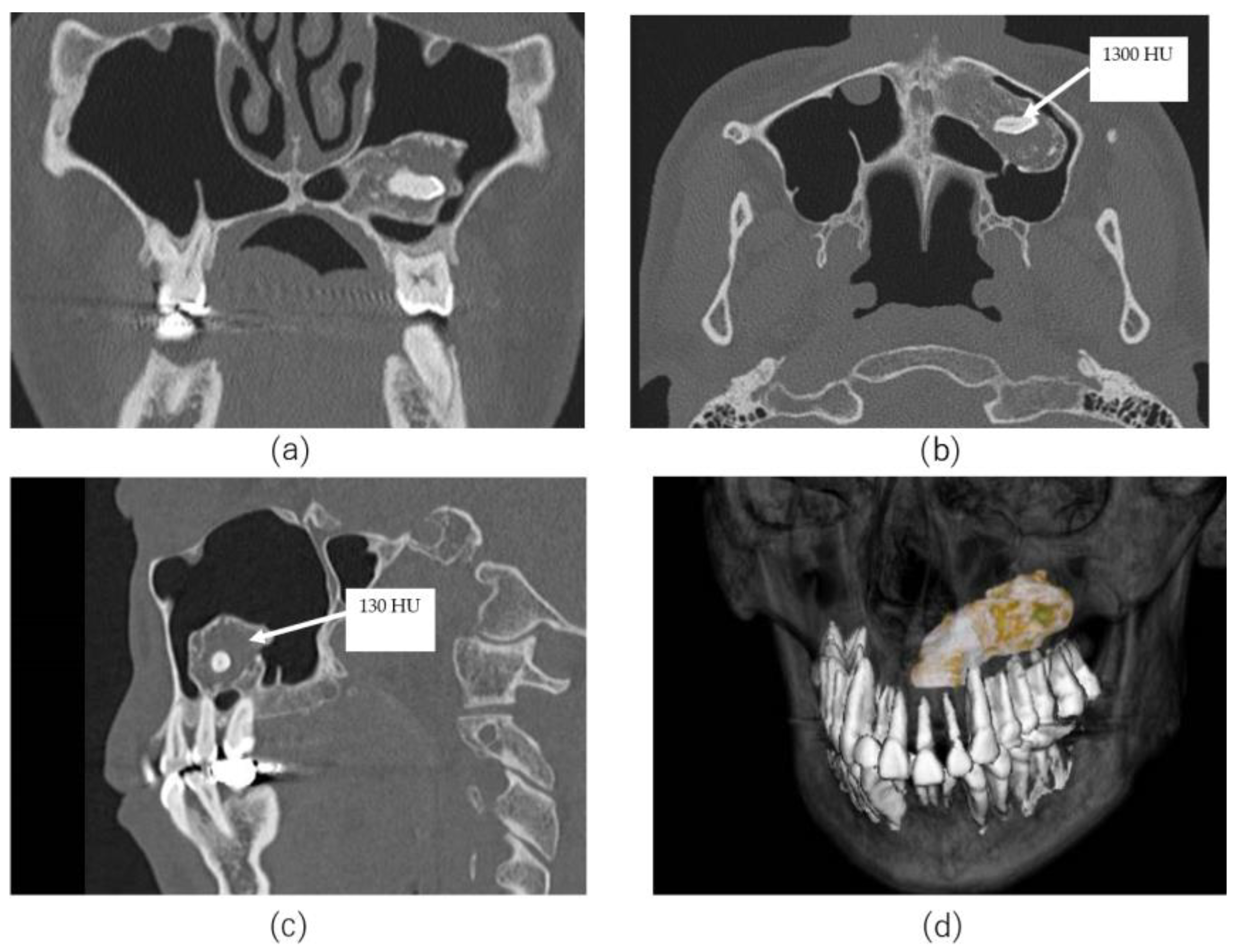 A Unique Case of Supernumerary Teeth Erupting Inside a Maxillary Sinus ...