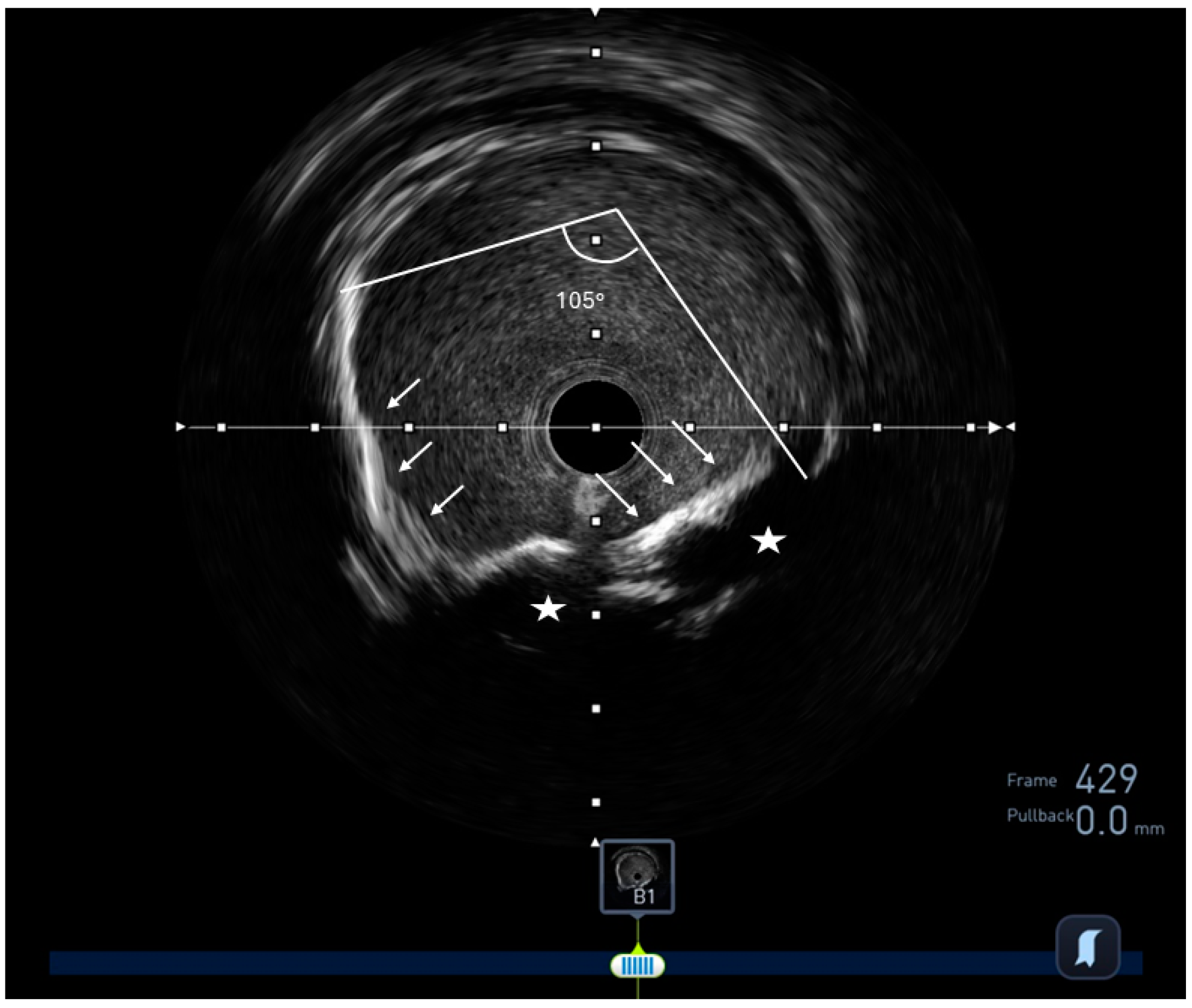Innovations in Intracoronary Imaging: Present Clinical Practices and ...