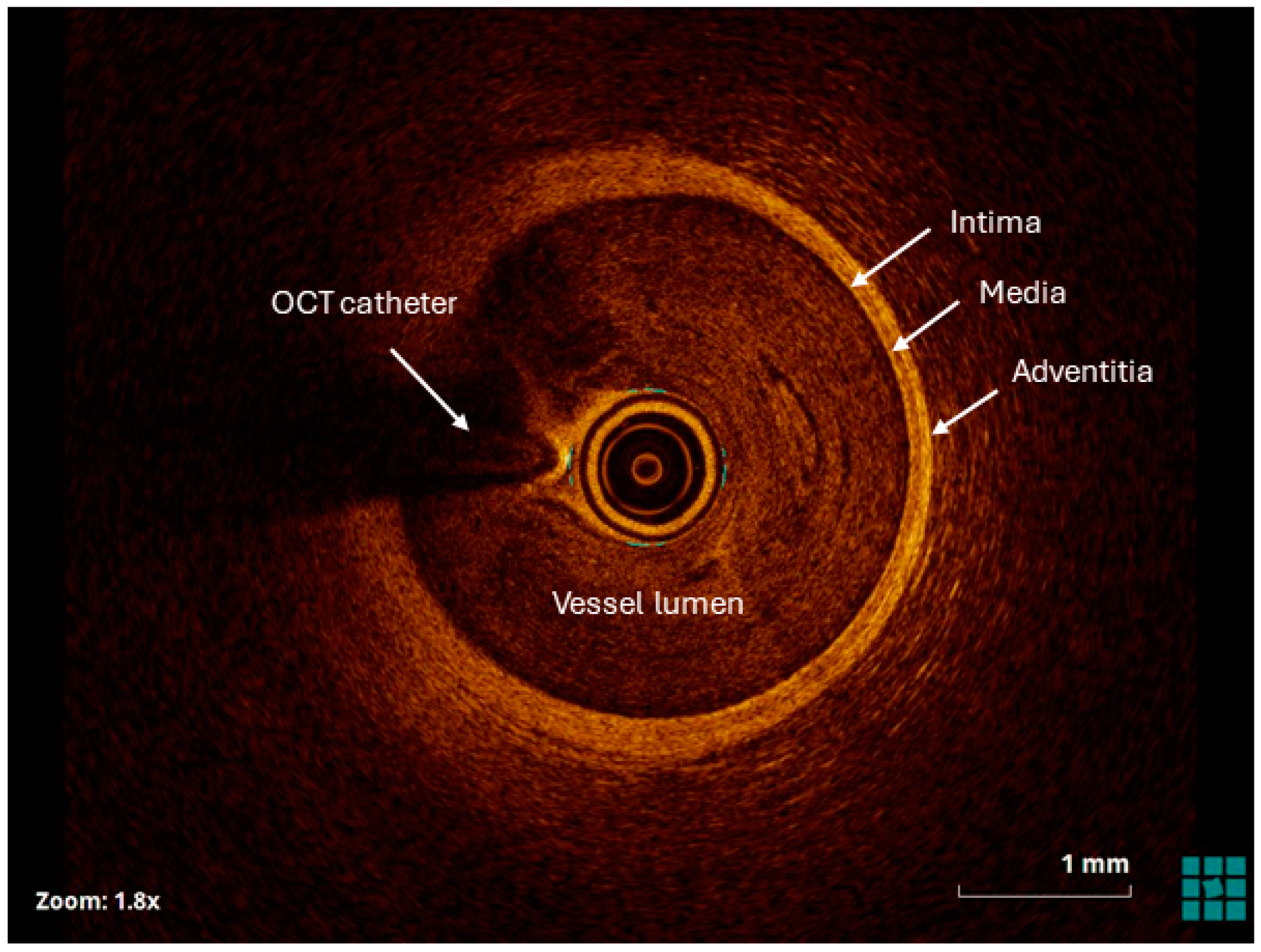 Innovations in Intracoronary Imaging: Present Clinical Practices and ...