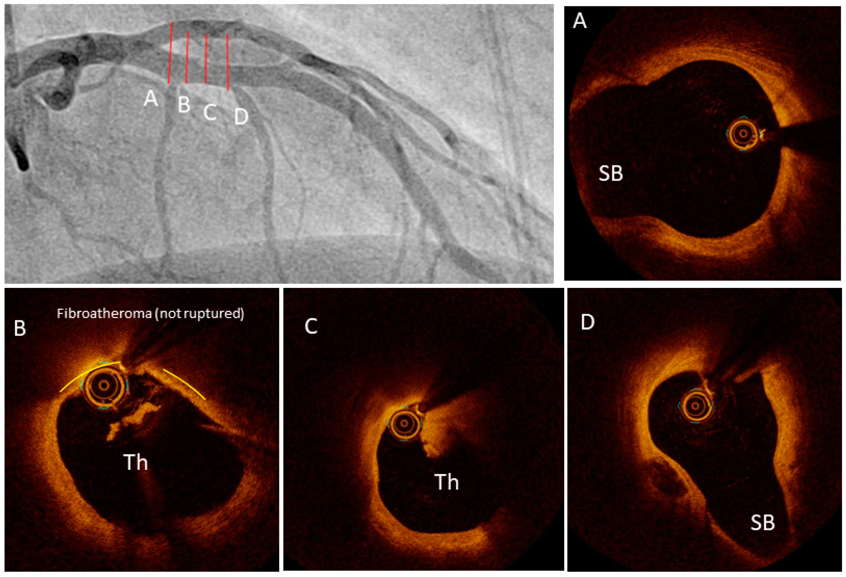 JCM | Free Full-Text | Innovations in Intracoronary Imaging: Present Clinical Practices and ...