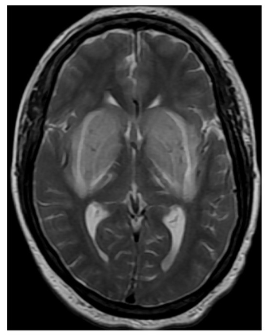 Magnetic Resonance Imaging in Uremic Encephalopathy: Identifying Key ...