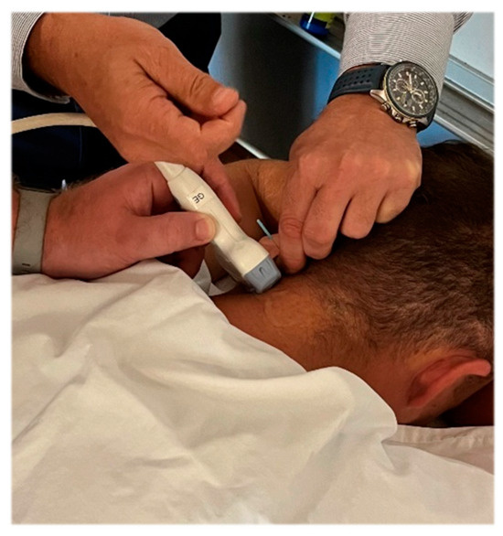JCM | Free Full-Text | The Immediate Effect of Dry Needling Electric ...