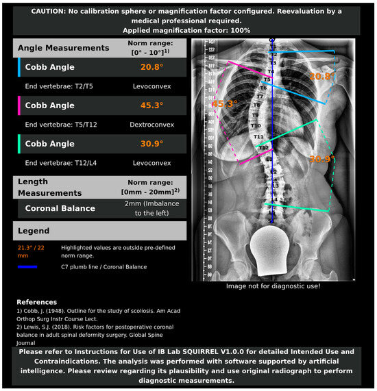 Fully Automated Measurement of Cobb Angles in Coronal Plane Spine ...