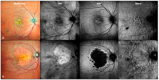 Retro Mode Imaging for Detection and Quantification of Sub-RPE Drusen ...