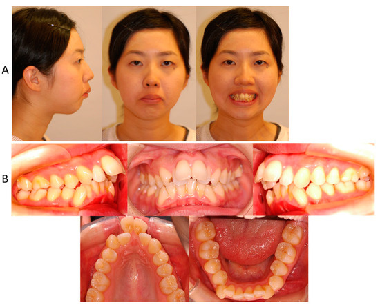 Severe Maxillary Protrusion Treated with Surgically Assisted Rapid ...