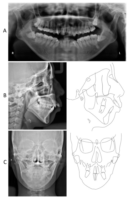 Severe Maxillary Protrusion Treated with Surgically Assisted Rapid ...