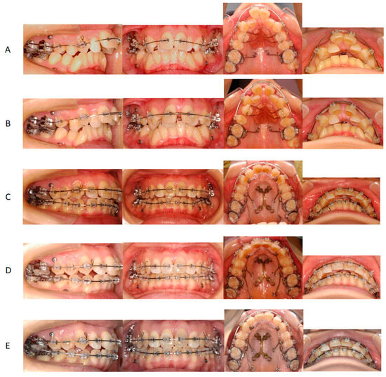 Severe Maxillary Protrusion Treated with Surgically Assisted Rapid ...