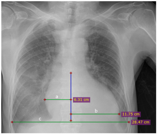 Deep Learning in Cardiothoracic Ratio Calculation and Cardiomegaly ...