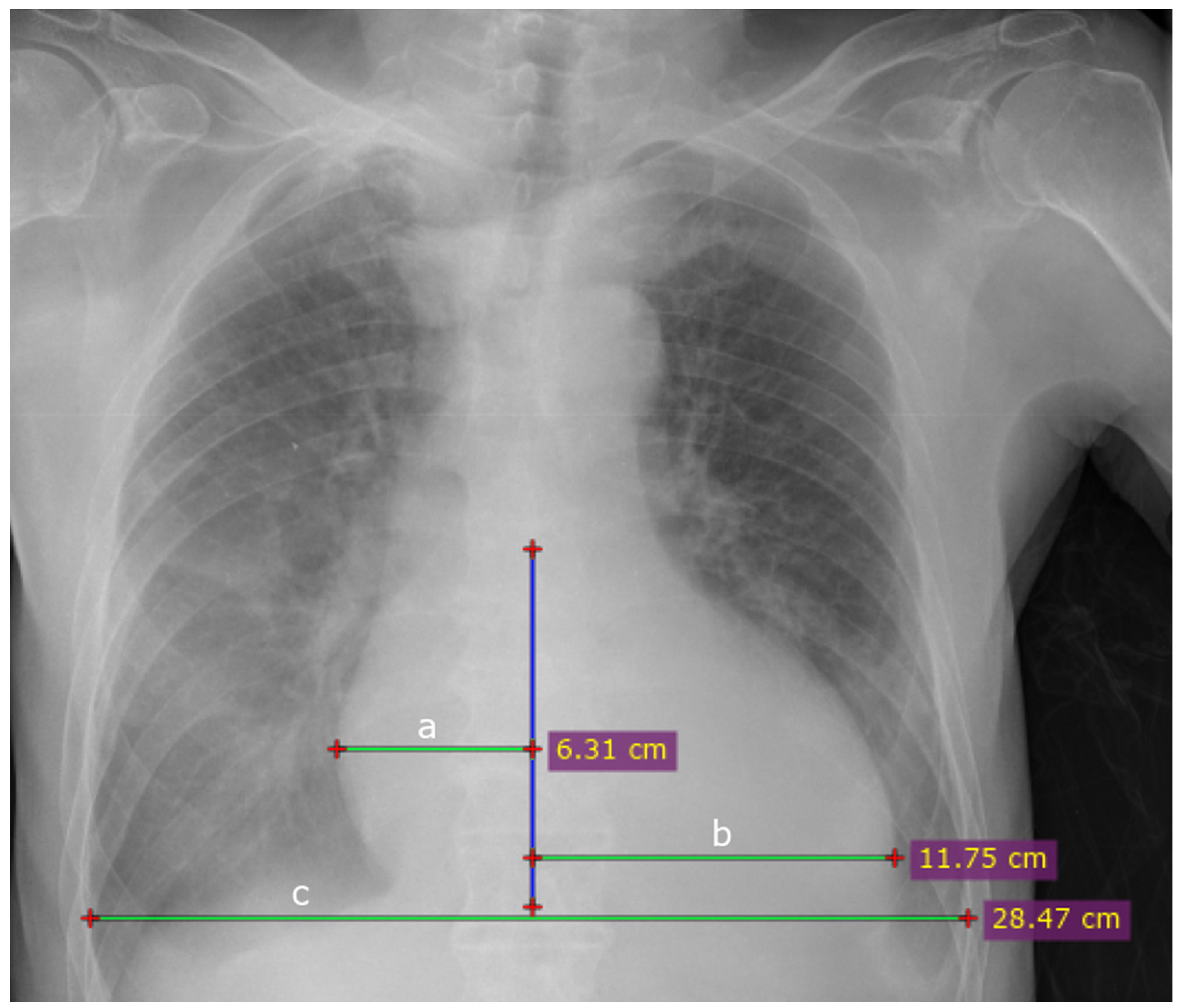 Deep Learning in Cardiothoracic Ratio Calculation and Cardiomegaly ...