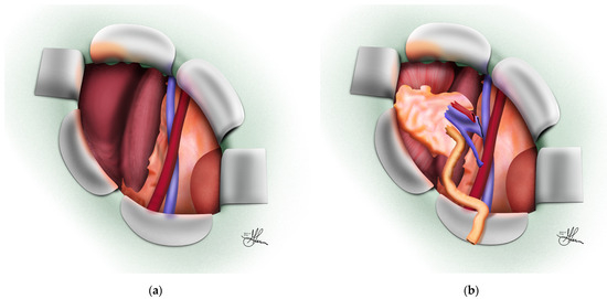 Surgical Strategies for Renal Transplantation: A Pictorial Essay