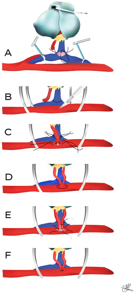 Surgical Strategies for Renal Transplantation: A Pictorial Essay