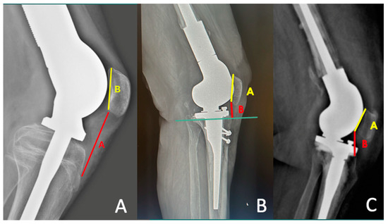 Does Patellar Height Influence Range of Motion and Anterior Knee Pain ...