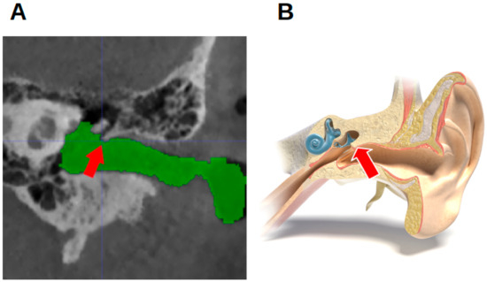 The Reproducibility of Reference Landmarks in the External Acoustic ...